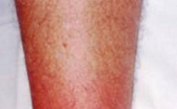 Celulitis, infecciones de la piel