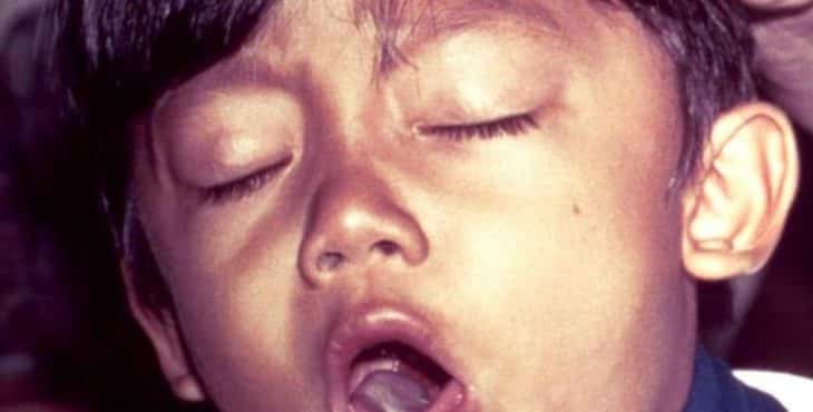 Tos Ferina, ¿quieres prevenirla de verdad?