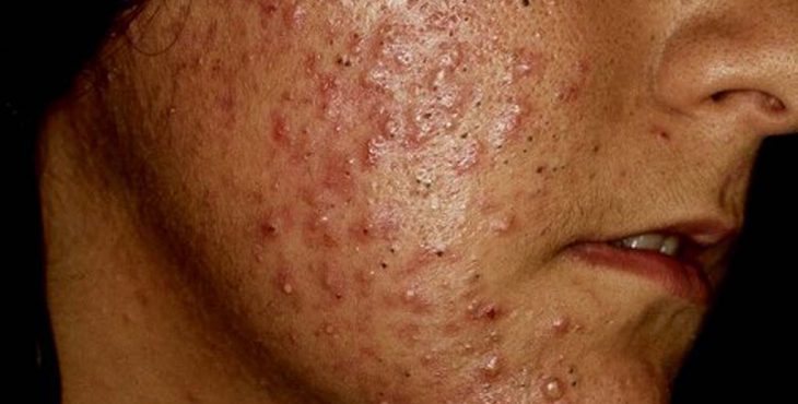 Descubre cómo eliminar el acné de tu vida para siempre