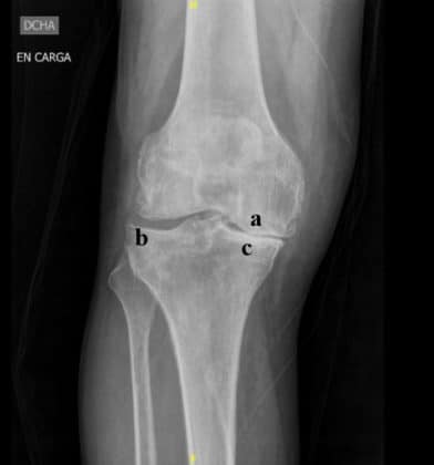 Artrosis de rodilla, información, diagnóstico y tratamientos