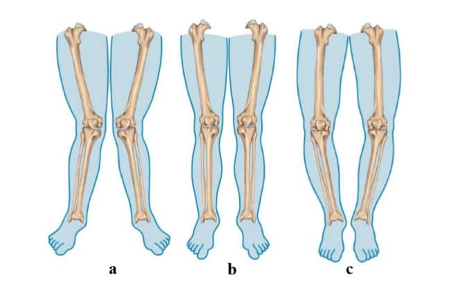 Artrosis de rodilla, información, diagnóstico y tratamientos