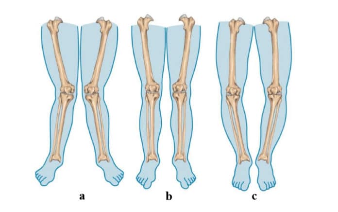 Artrosis de rodilla, información, diagnóstico y tratamientos